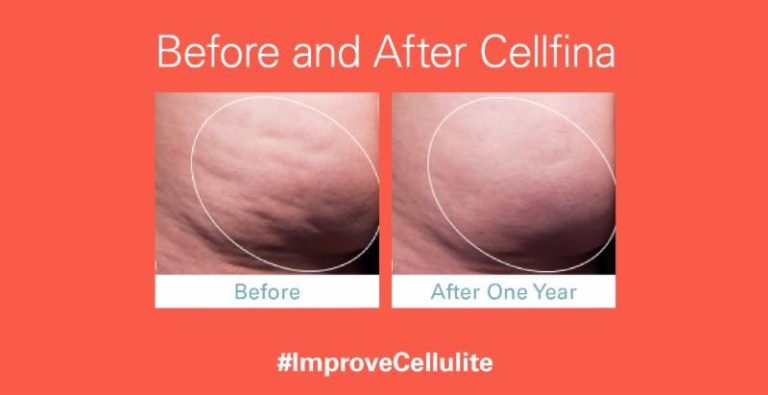 Reduce Cellulite Effectively with Cellfina in Beverly Hills, CA